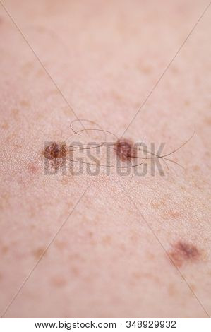 Checking Benign Moles Image & Photo (Free Trial) | Bigstock