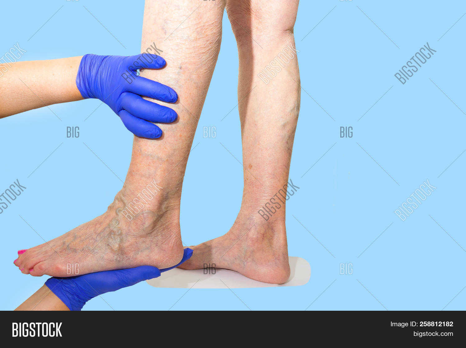 Lower Limb Vascular Image & Photo (Free Trial) | Bigstock