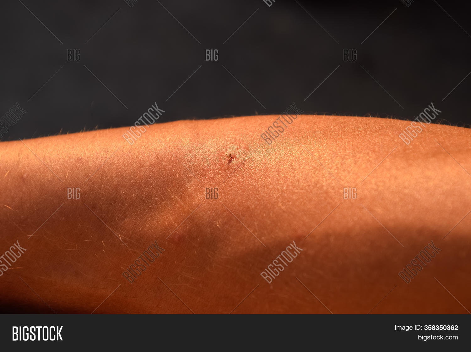 Bee Sting. Bee Sting Image & Photo (Free Trial) | Bigstock