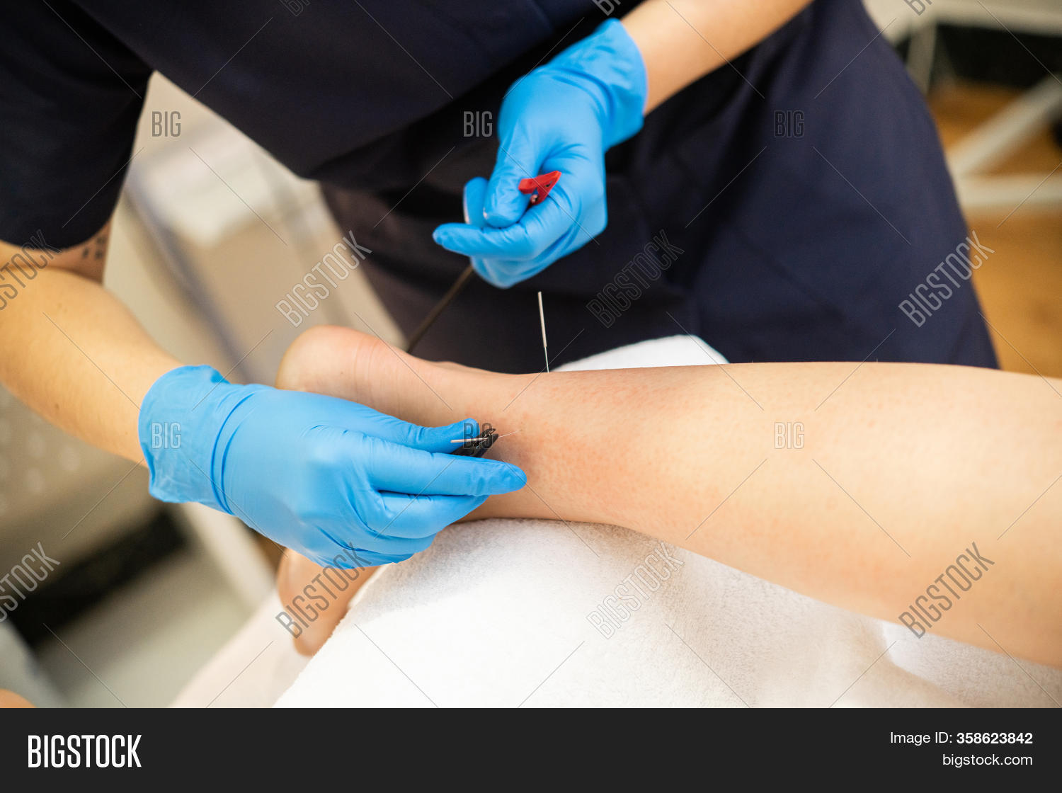 Electro Acupuncture Image & Photo (Free Trial) | Bigstock
