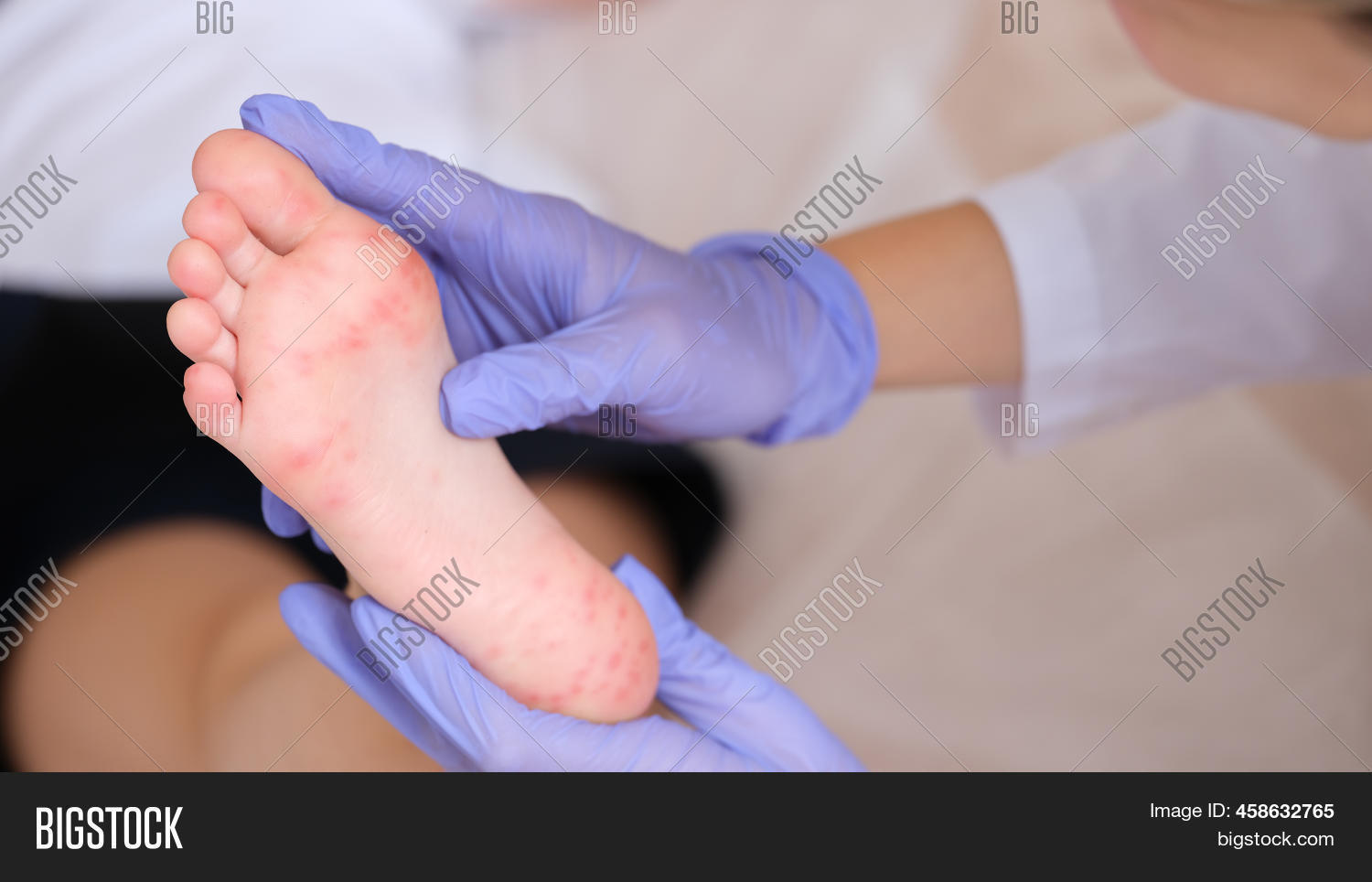 Rash Enterovirus Image & Photo (Free Trial) | Bigstock