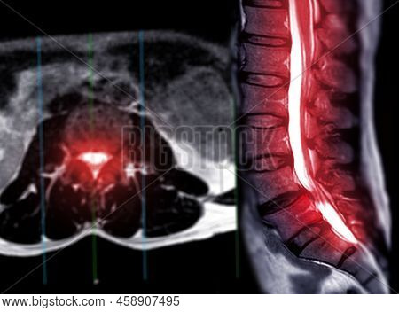 Mri L-s Spine Lumbar Image & Photo (Free Trial) | Bigstock