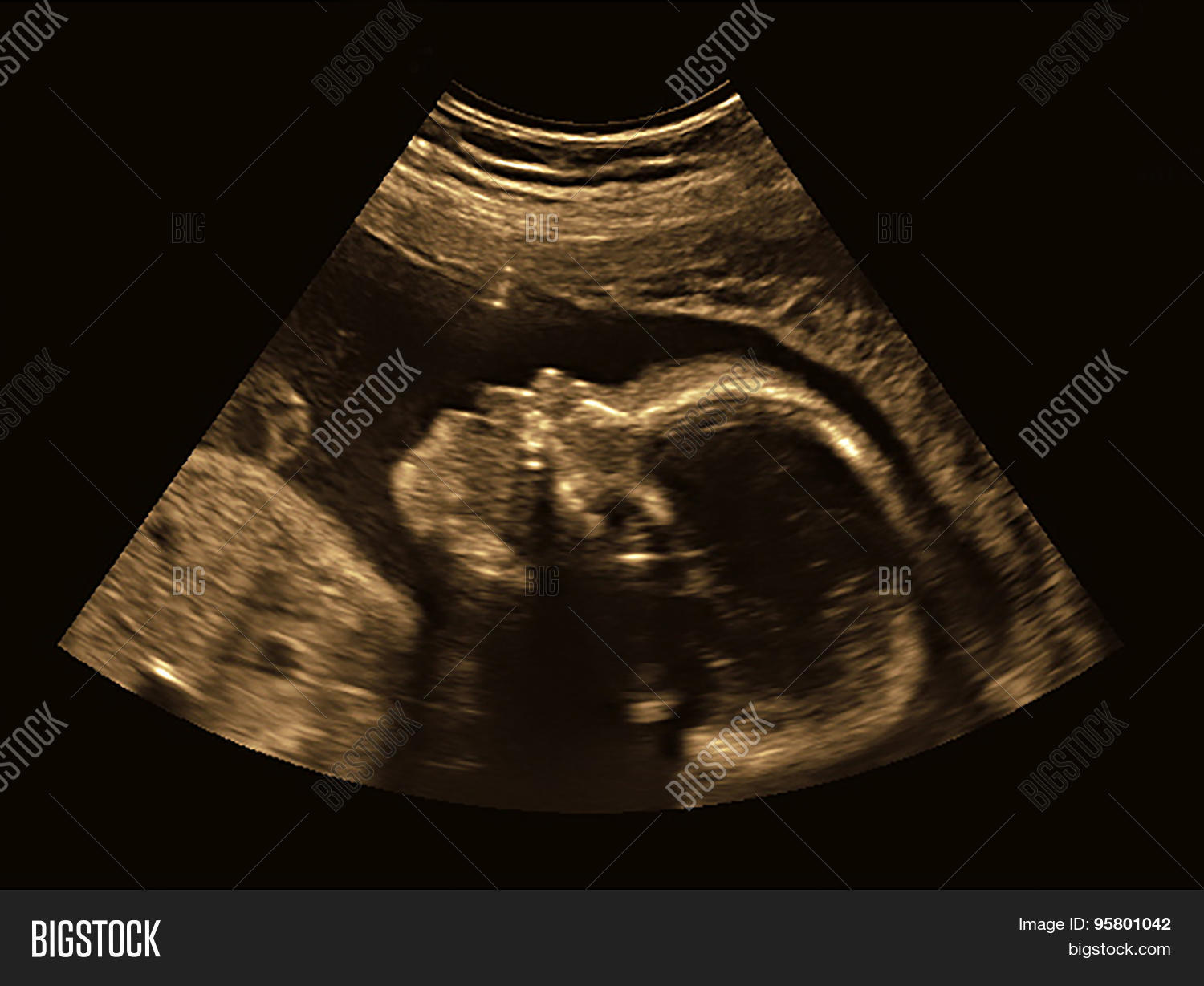 Ultrasound Baby Image & Photo (Free Trial) | Bigstock