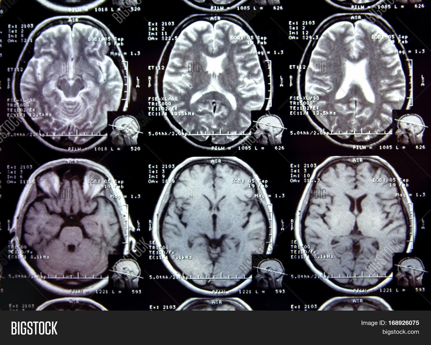 Closeup View MRI Head Image & Photo (Free Trial) | Bigstock