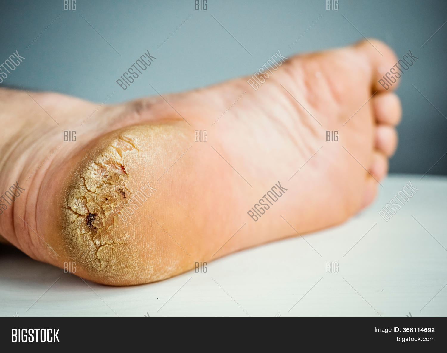 Cracked Callosity Male Image & Photo (Free Trial) | Bigstock