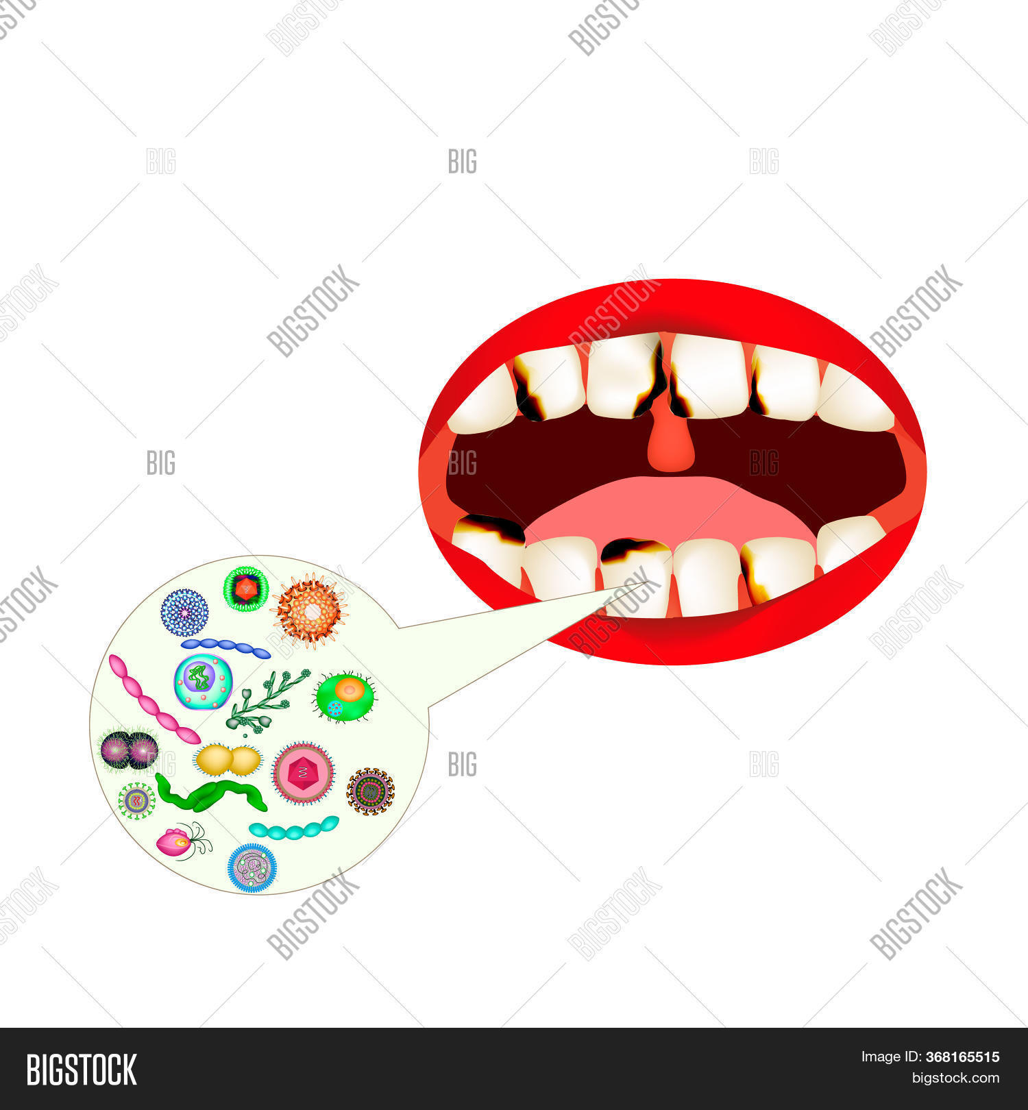 Caries. Smell Mouth. Image & Photo (Free Trial) | Bigstock