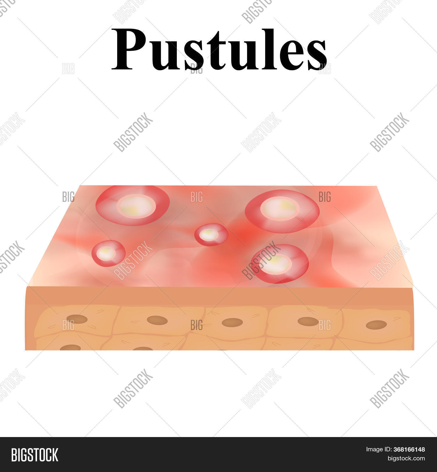 Pustules. Acne On Skin Image & Photo (Free Trial) | Bigstock