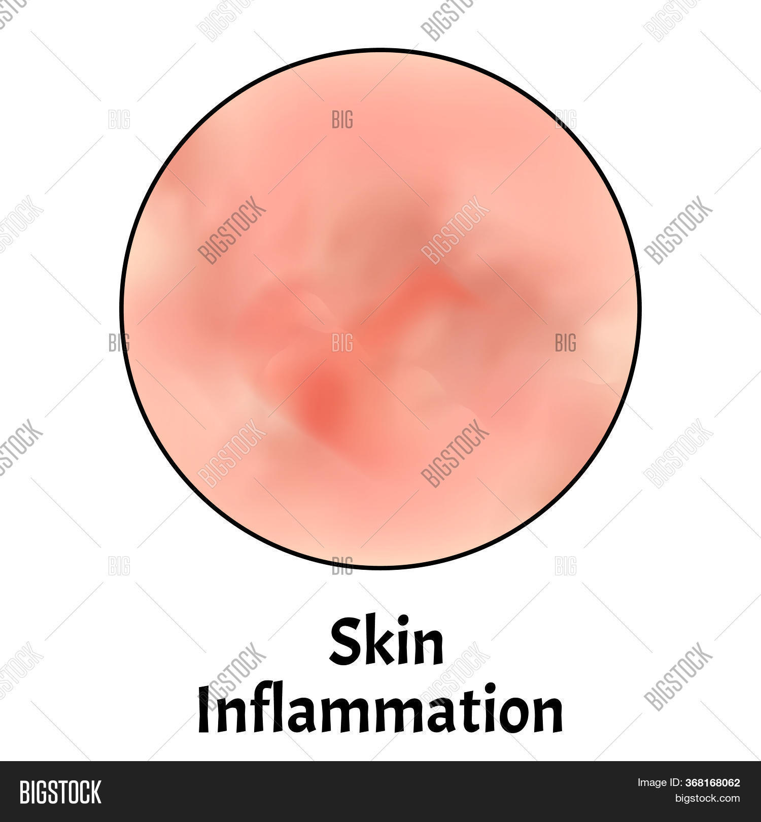 Skin Inflammation. Image & Photo (Free Trial) | Bigstock