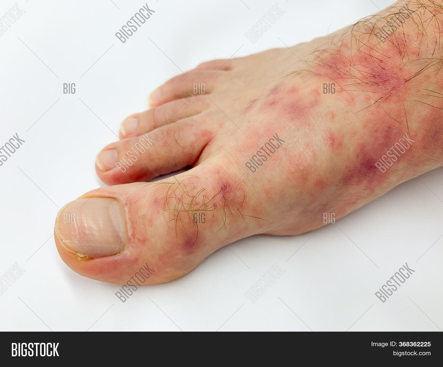 Close Male's Foot Toes Image & Photo (Free Trial) | Bigstock