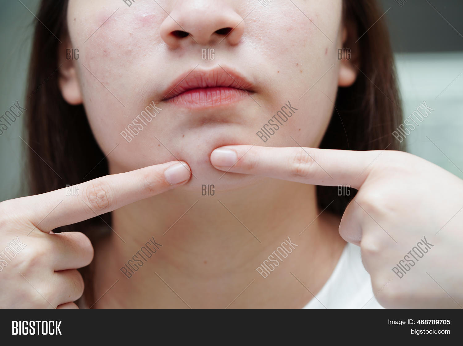 Acne Pimple Scar On Image & Photo (Free Trial) | Bigstock