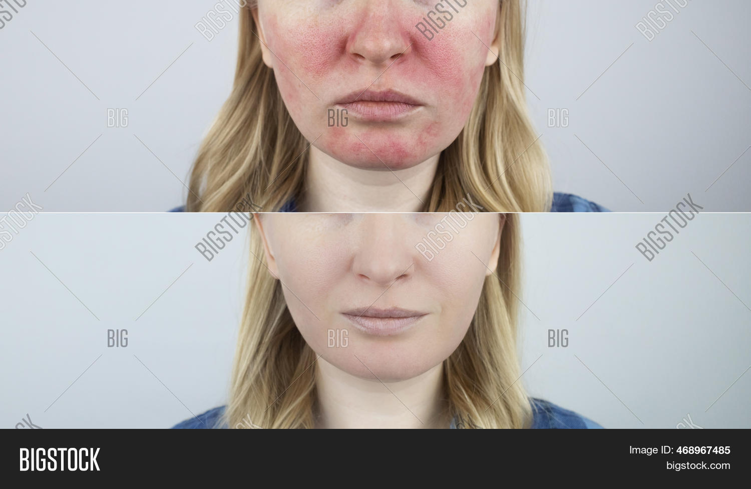 Rosacea Face. Girl Image & Photo (Free Trial) | Bigstock