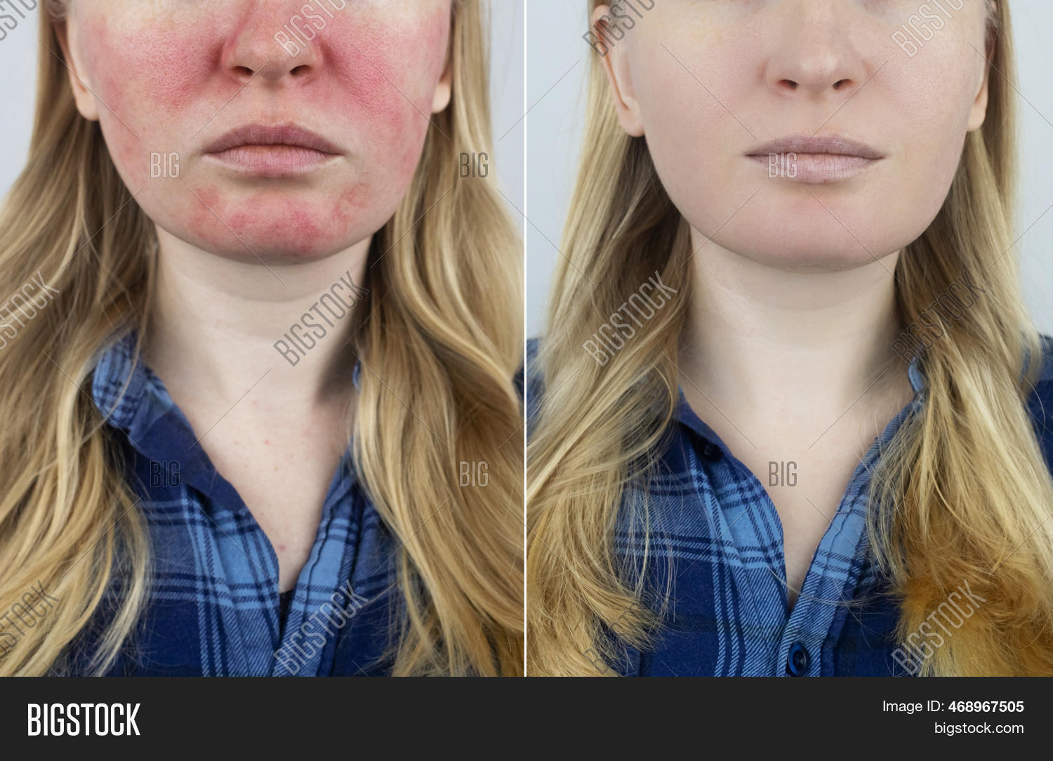 Rosacea Face. Girl Image & Photo (Free Trial) | Bigstock