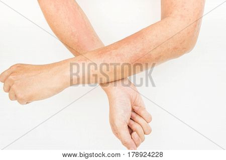 Skin Rashes Allergies Image & Photo (Free Trial) | Bigstock