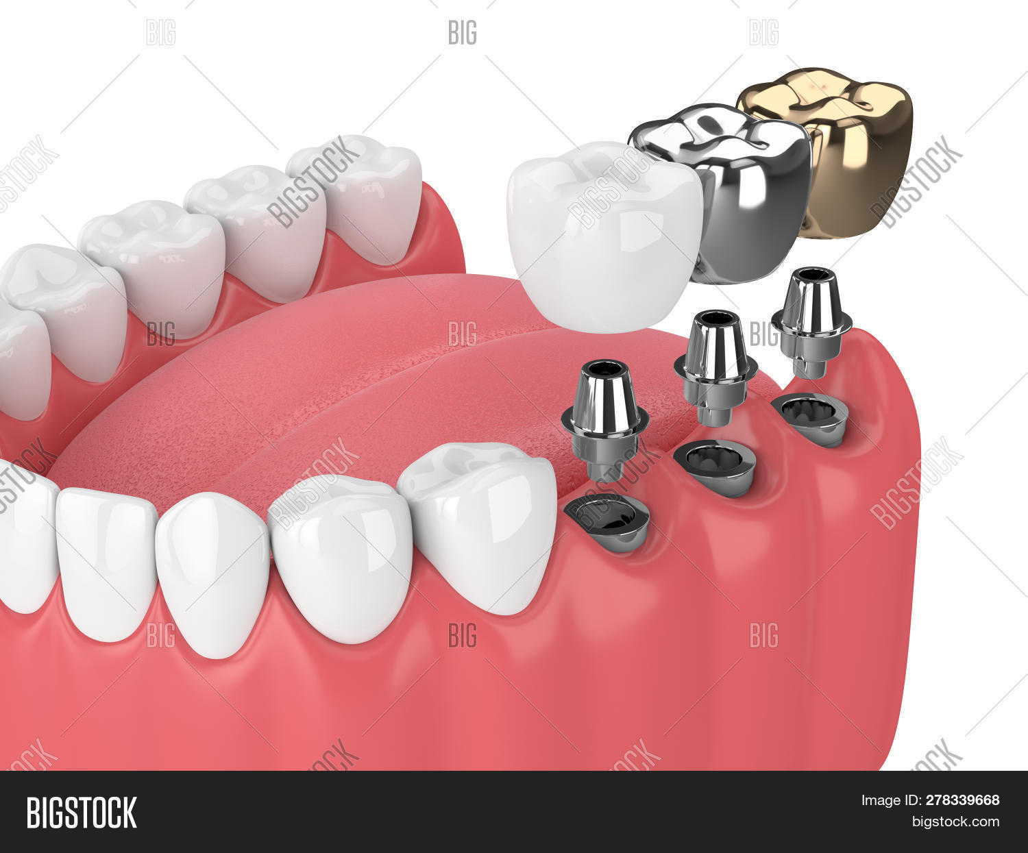 3D Render Teeth Image & Photo (Free Trial) | Bigstock