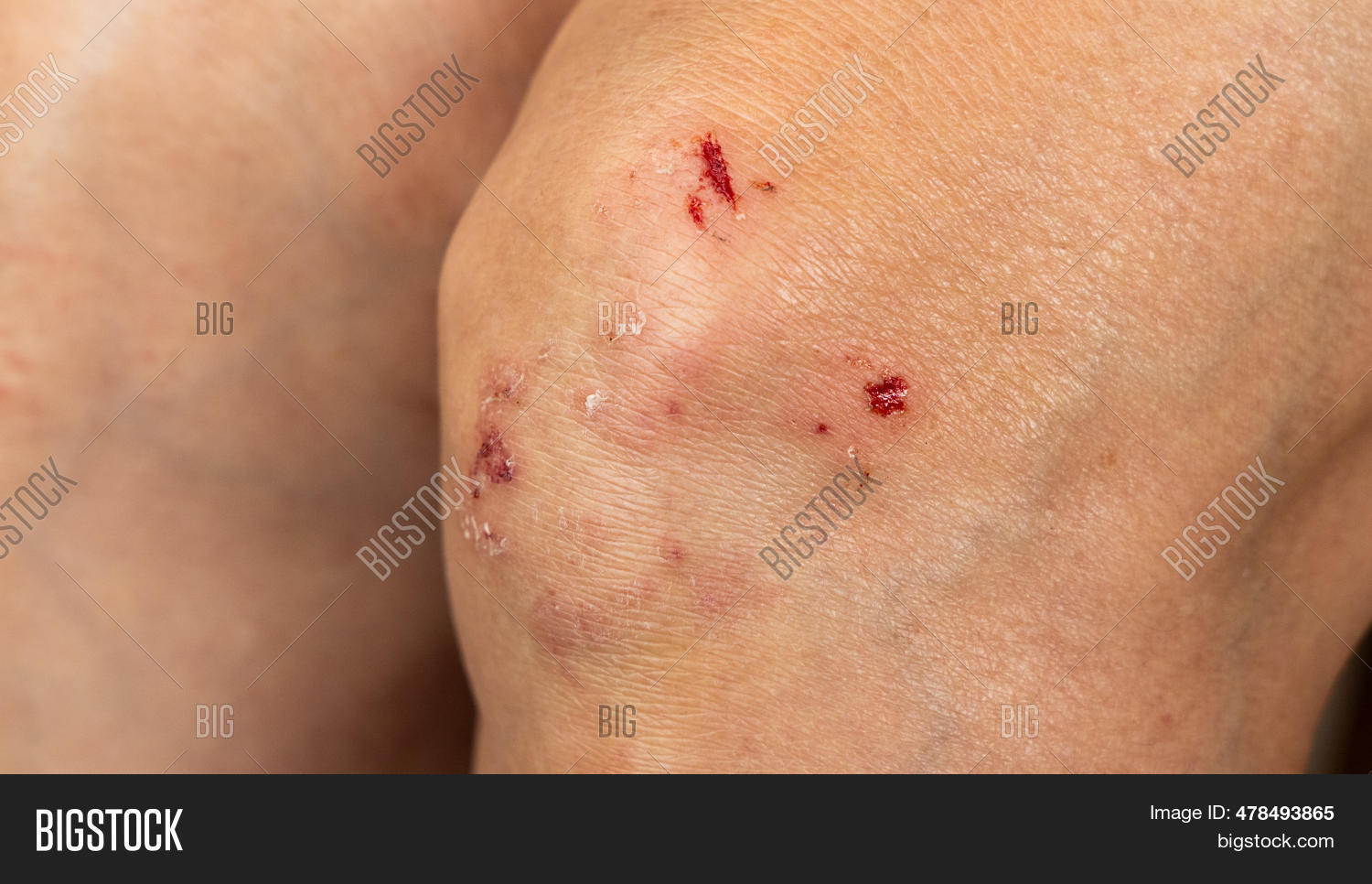 Closeup On Bleeding Image & Photo (Free Trial) | Bigstock
