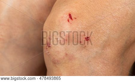 Closeup On Bleeding Image & Photo (Free Trial) | Bigstock