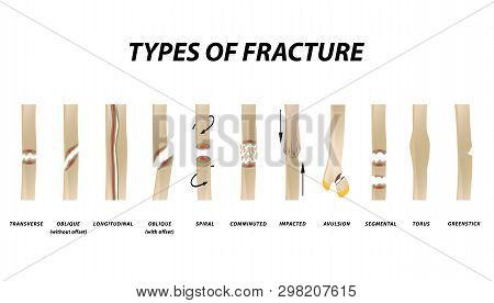 Types Fracture. Vector & Photo (Free Trial) | Bigstock