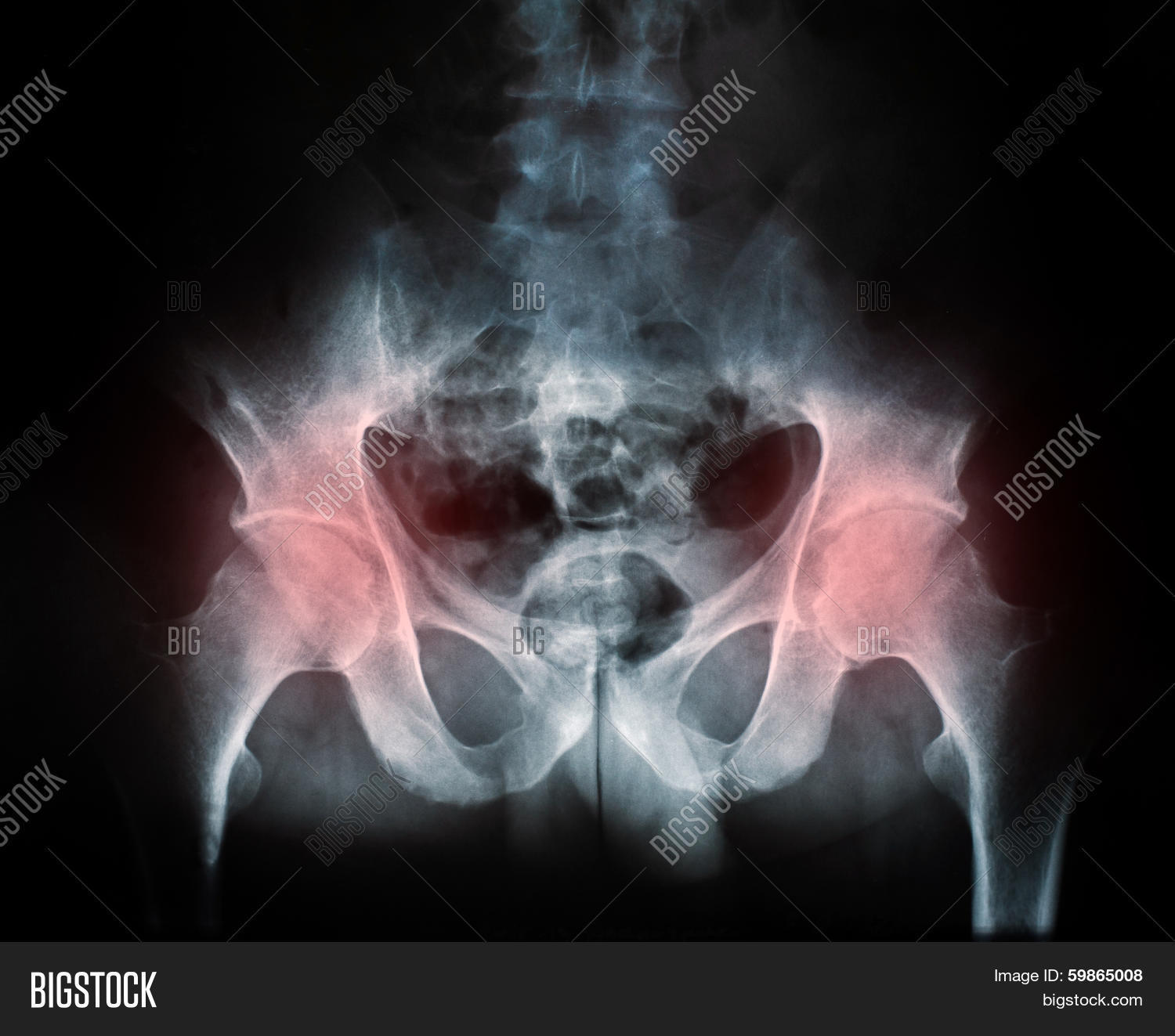 X-ray Human Break Hip Image & Photo (Free Trial) | Bigstock