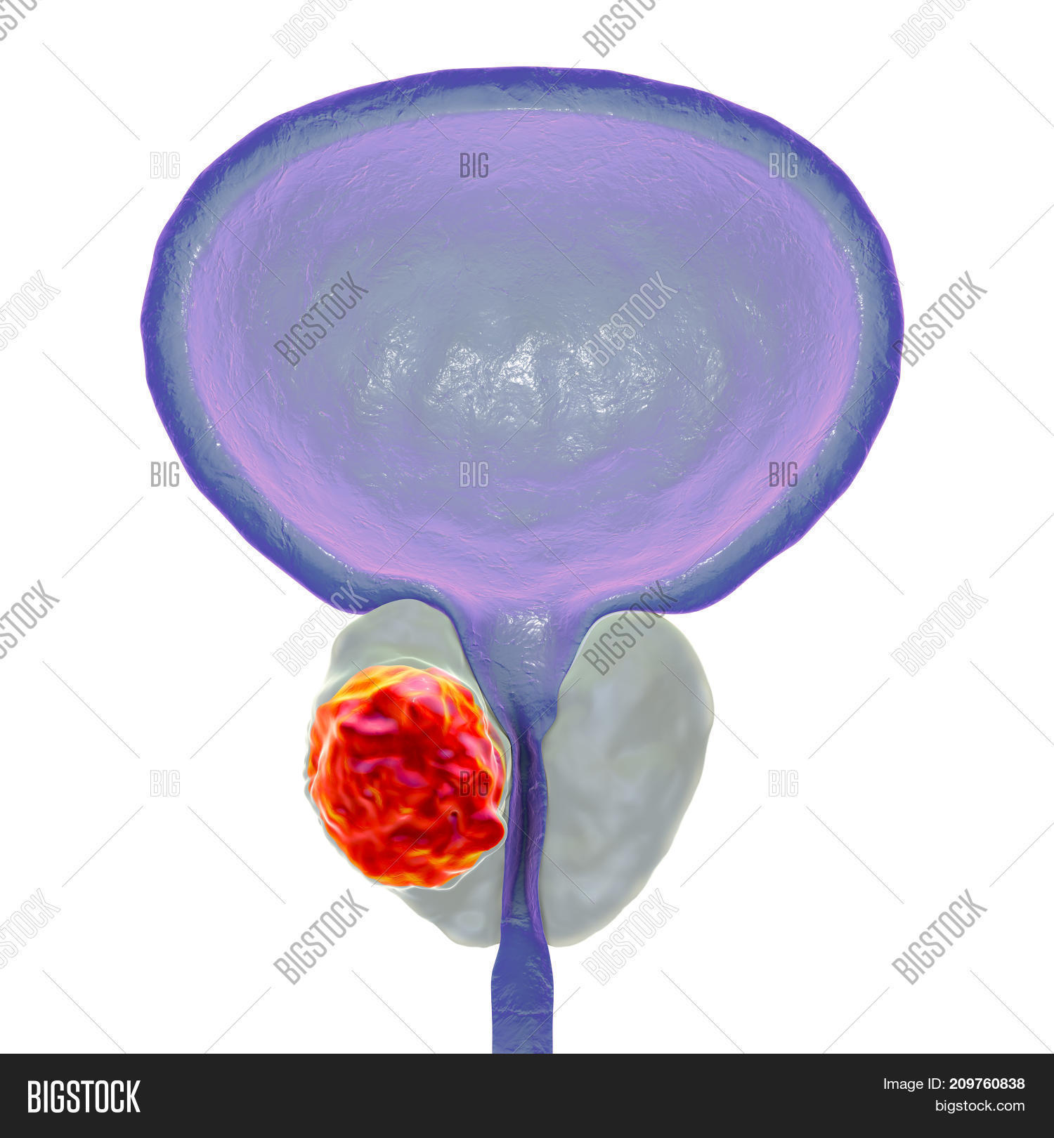Prostate Cancer, 3D Image & Photo (Free Trial) | Bigstock