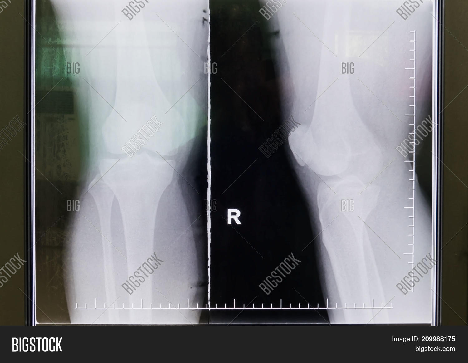 Black White Knee Film Image & Photo (Free Trial) | Bigstock