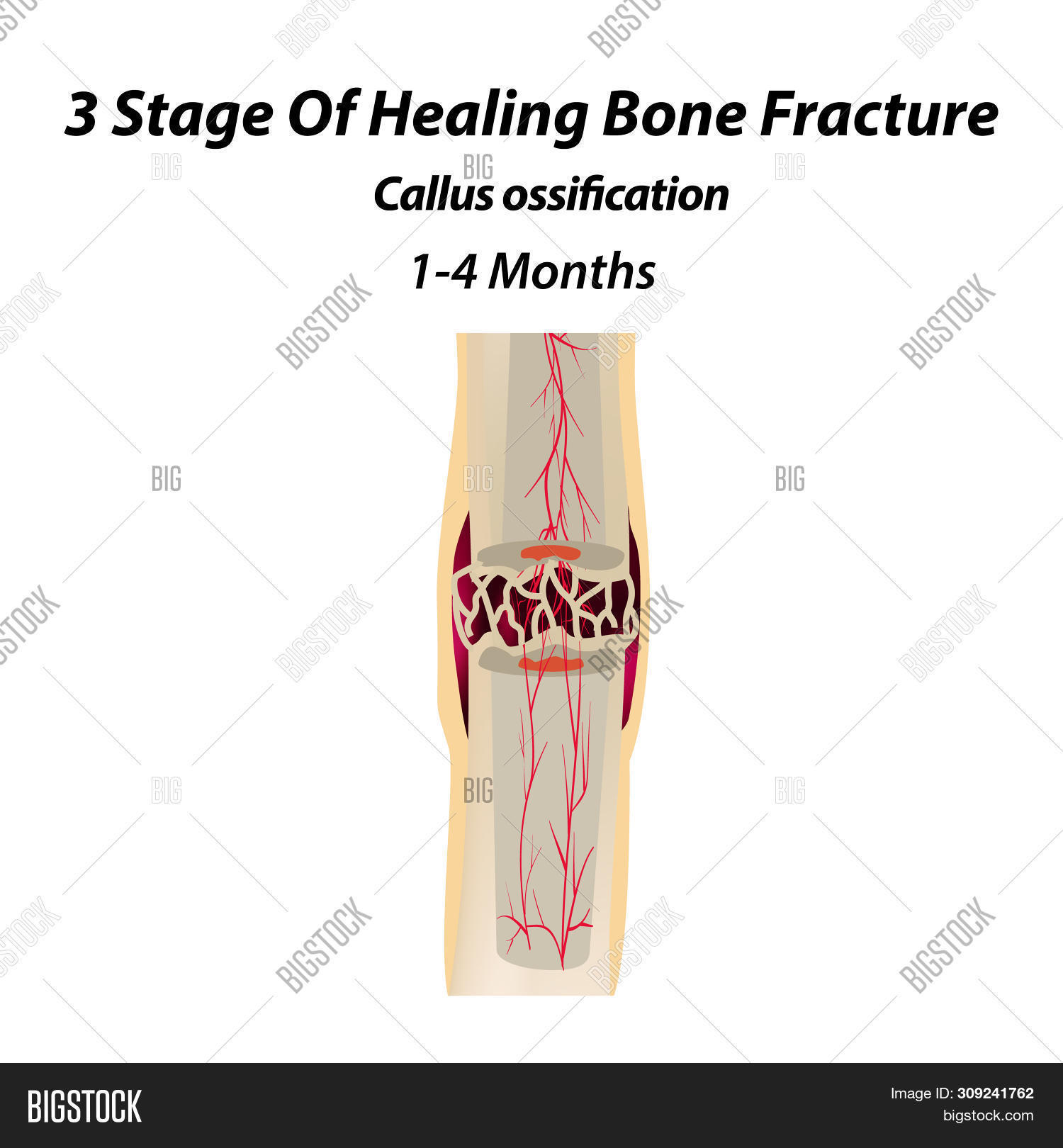 3 Stage Healing Bone Image & Photo (Free Trial) | Bigstock