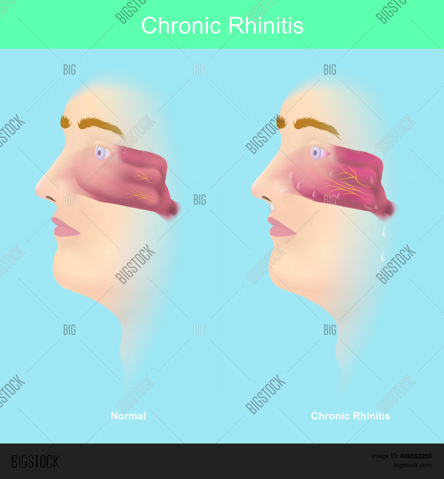 Chronic Rhinitis. Vector & Photo (Free Trial) | Bigstock