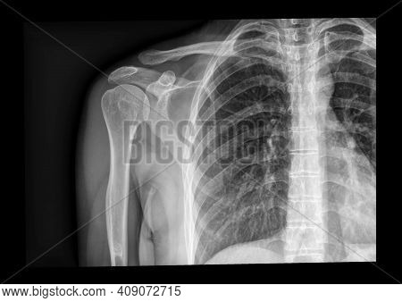 X-ray Shoulder Image & Photo (Free Trial) | Bigstock