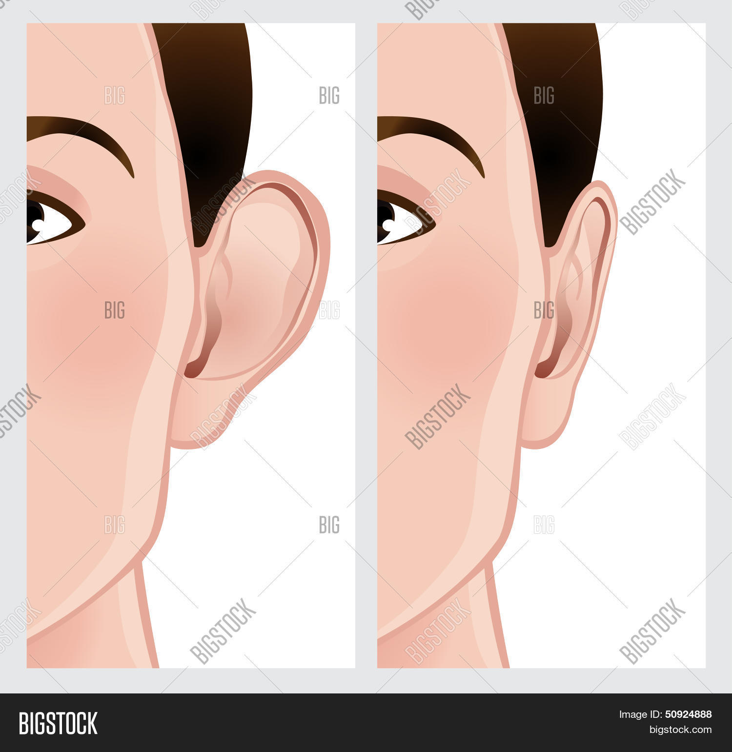Ear Reshaping Image & Photo (Free Trial) | Bigstock