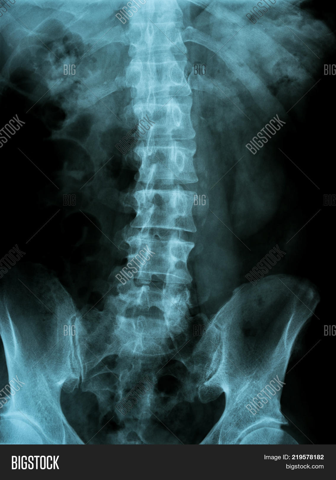 Pelvis Spinal Column X Image & Photo (Free Trial) | Bigstock
