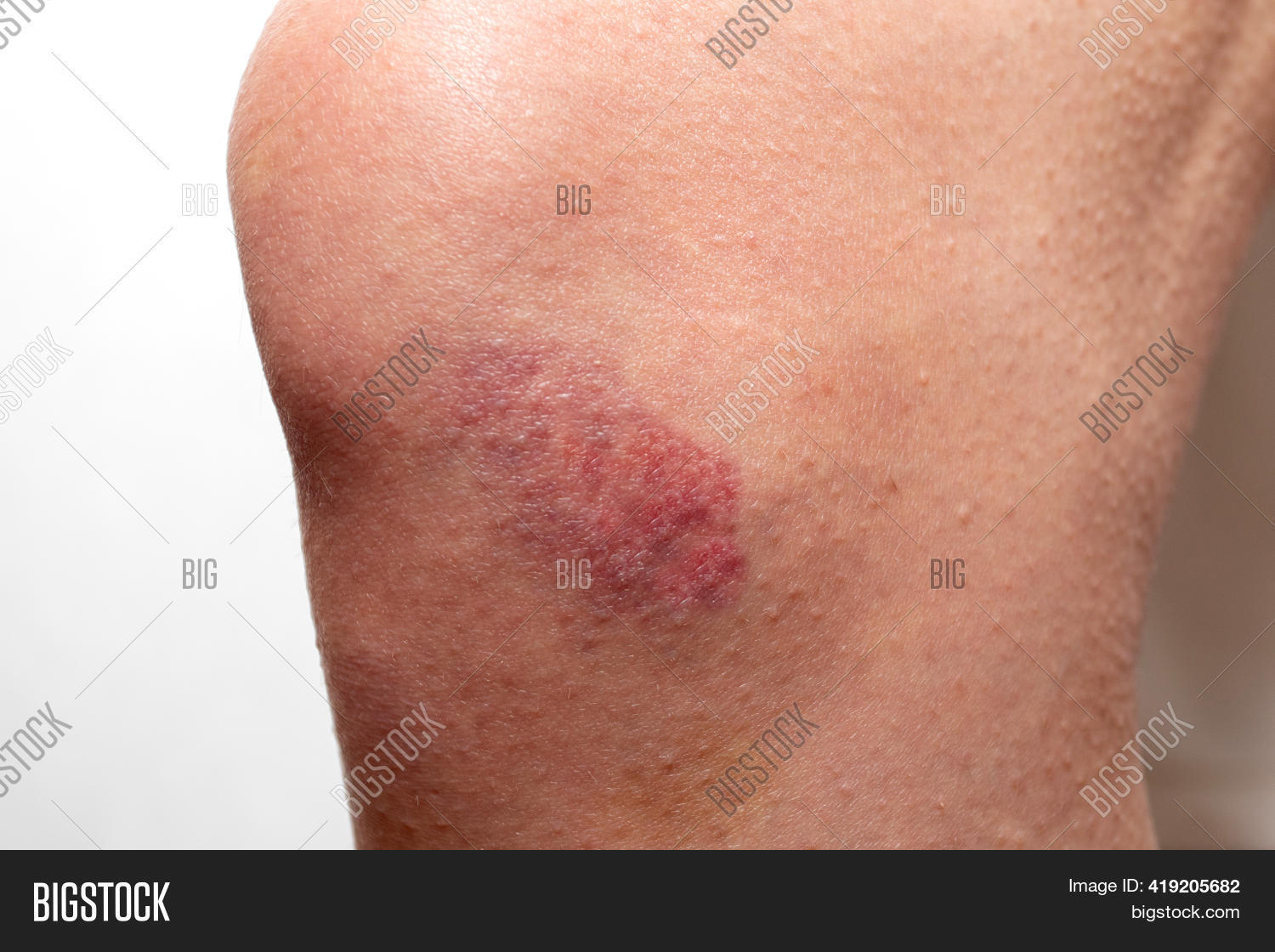 Big Red Bruise On Knee Image & Photo (Free Trial) | Bigstock