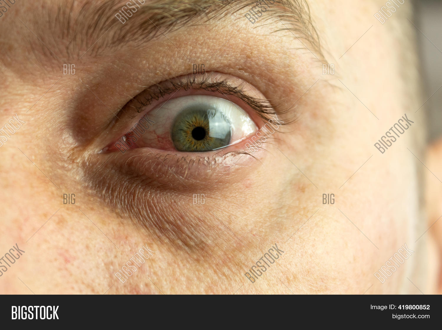 Red Inflamed Eye Close Image & Photo (Free Trial) | Bigstock