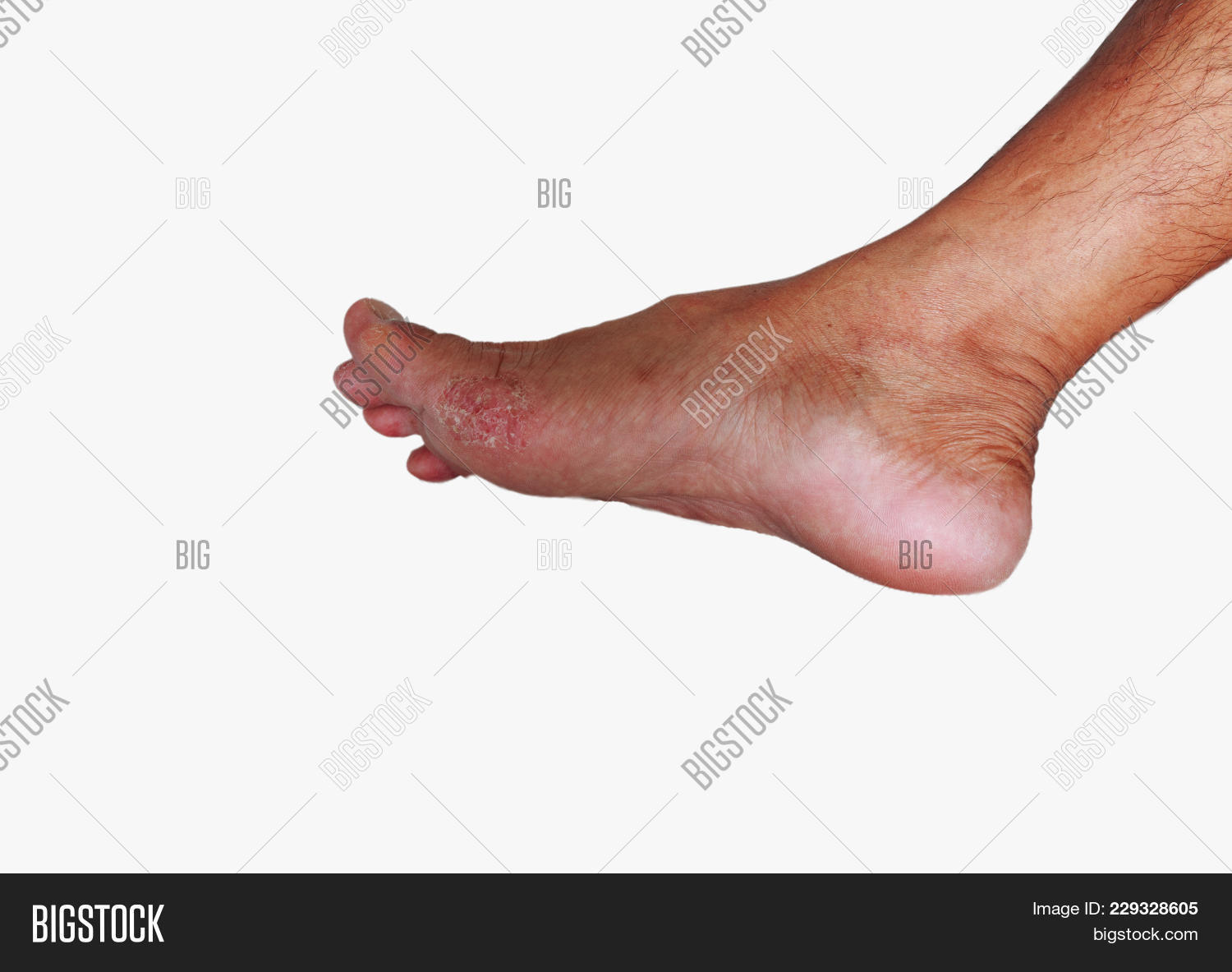 Foot Fungal Infection Image & Photo (Free Trial) | Bigstock