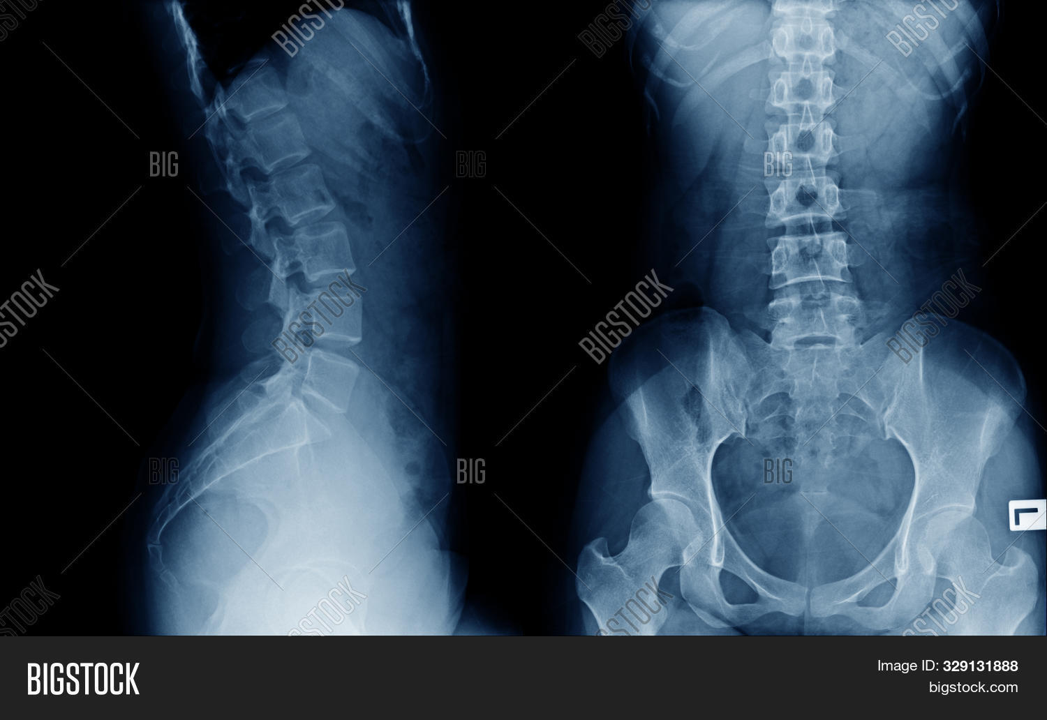 Back X-ray Image Ap Image & Photo (Free Trial) | Bigstock