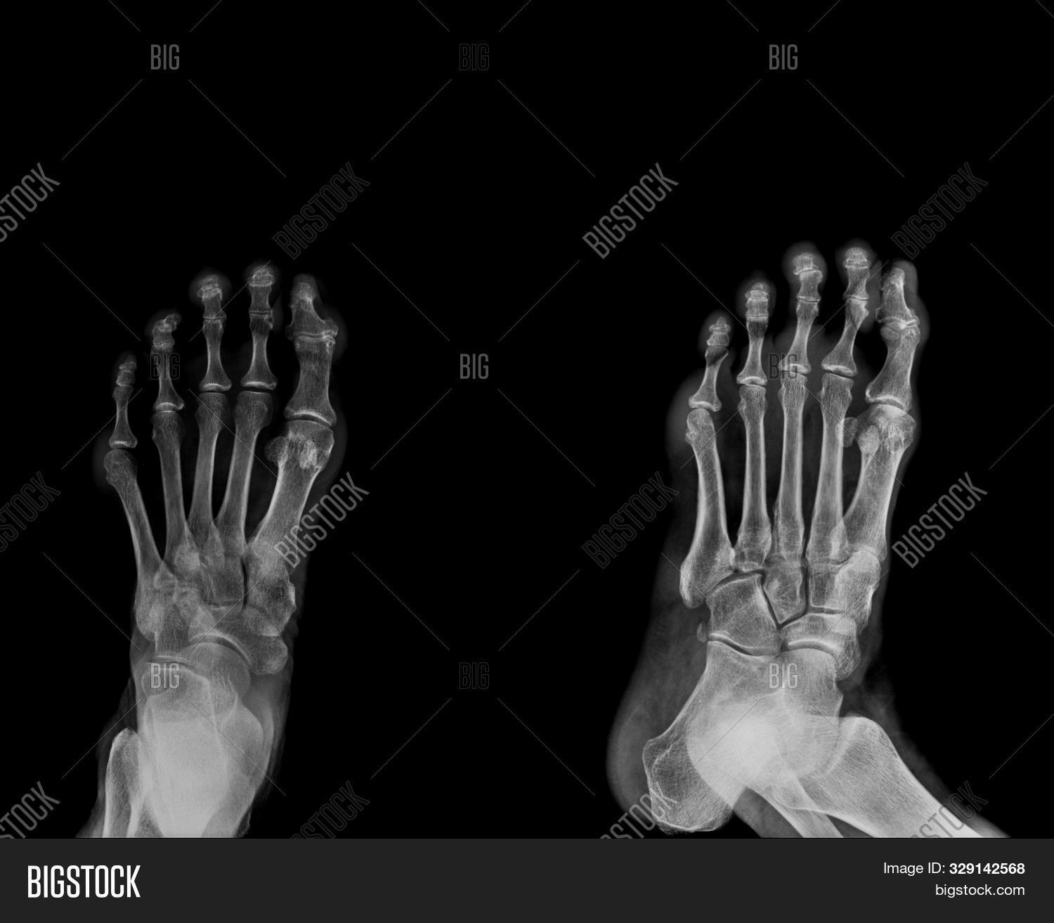 Foot X-ray Ap Lateral Image & Photo (Free Trial) | Bigstock