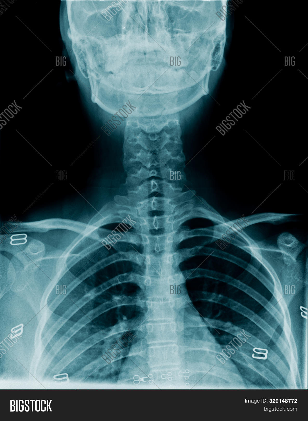 Cervical Spine X-ray Image & Photo (Free Trial) | Bigstock