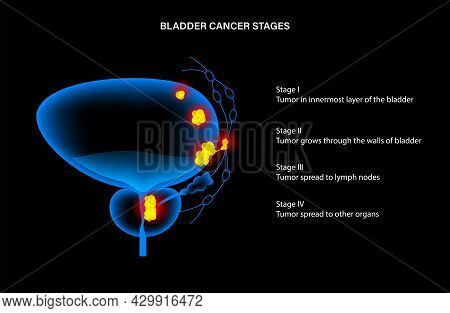 Bladder Cancer Stages Vector & Photo (Free Trial) | Bigstock