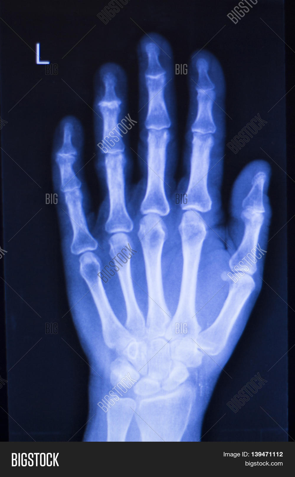 Hand Injury Fingers Image & Photo (Free Trial) | Bigstock
