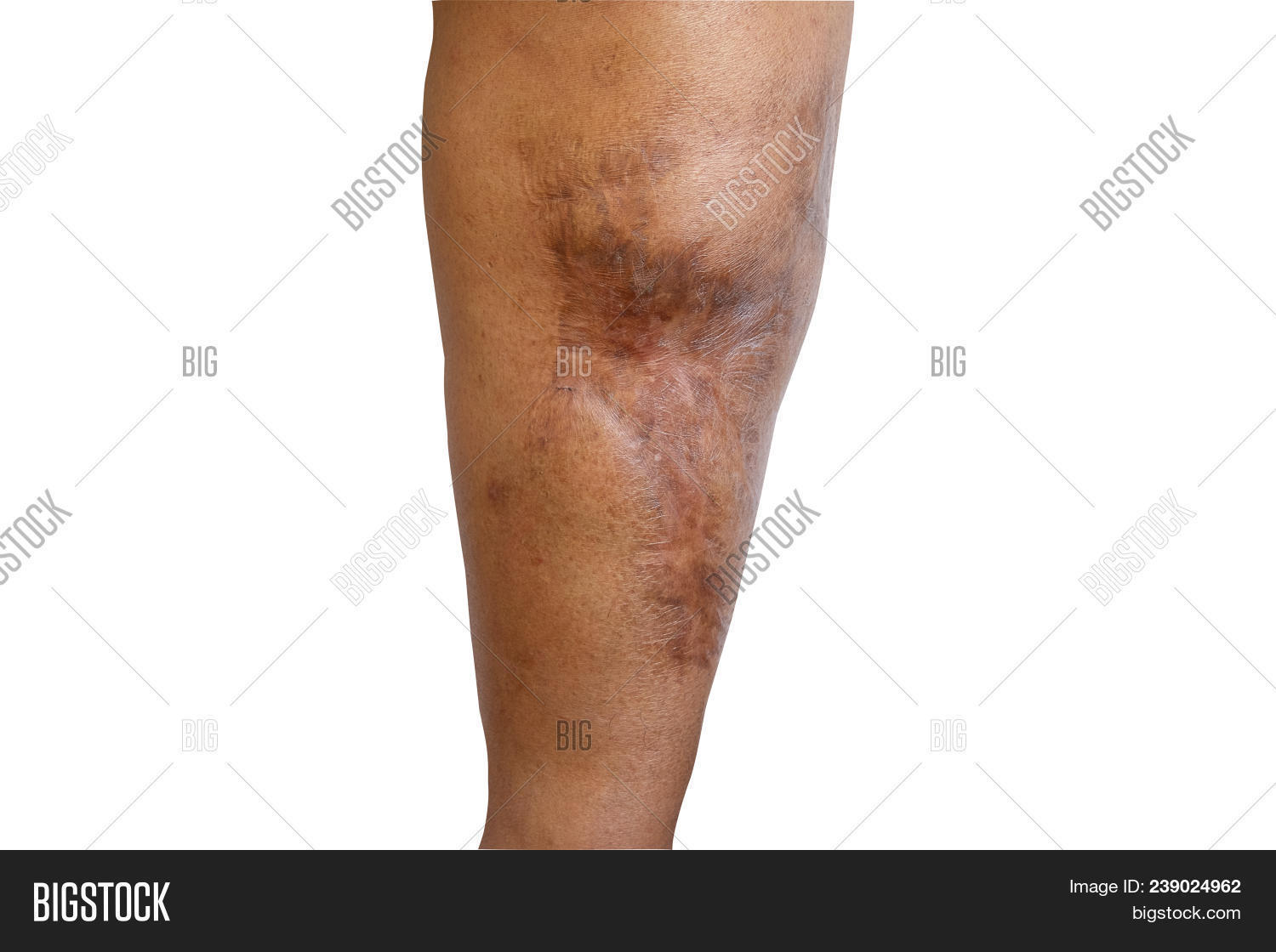 Large Scarring Occurs Image & Photo (Free Trial) | Bigstock