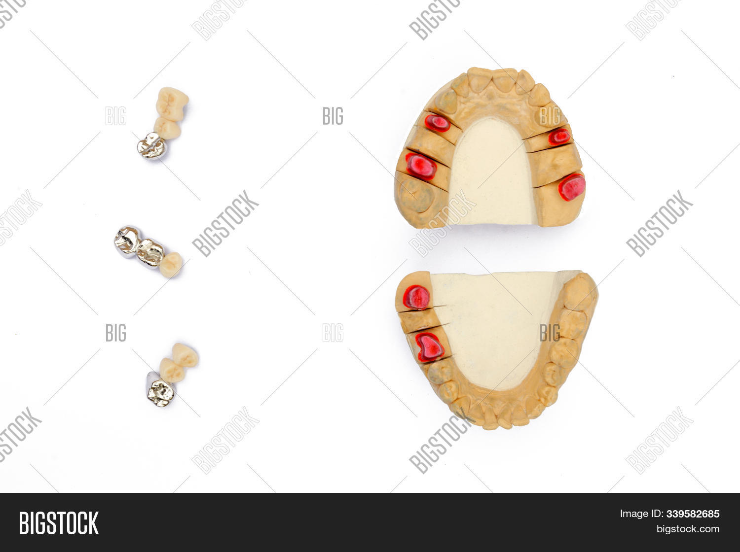 Dental Prosthetics. Image & Photo (Free Trial) | Bigstock