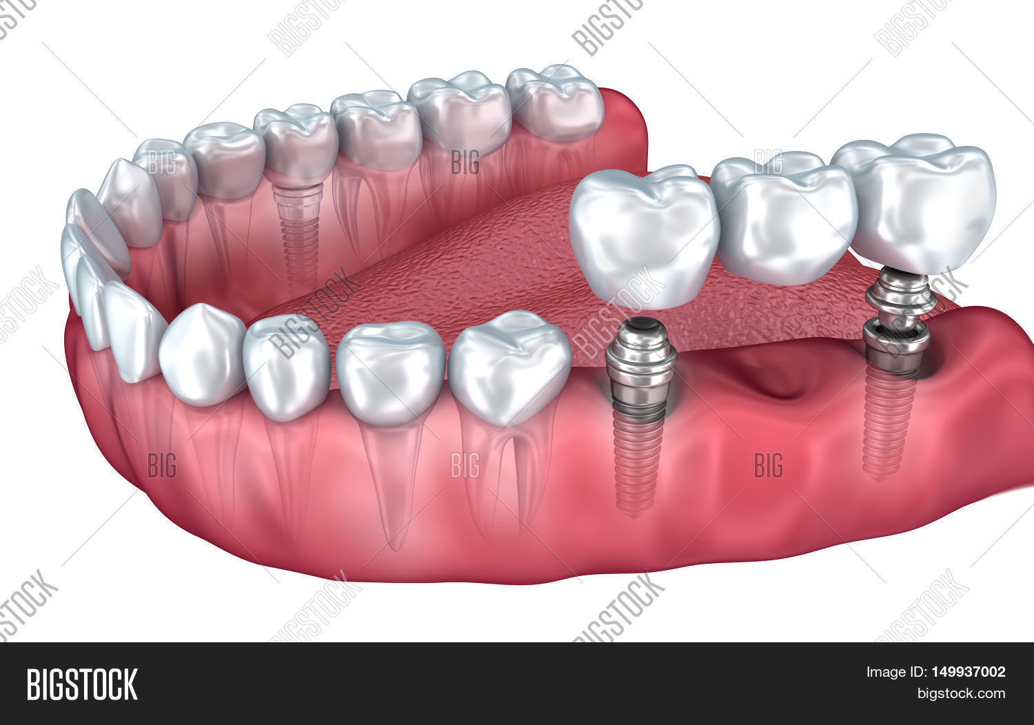 Lower Teeth Dental Image & Photo (Free Trial) | Bigstock