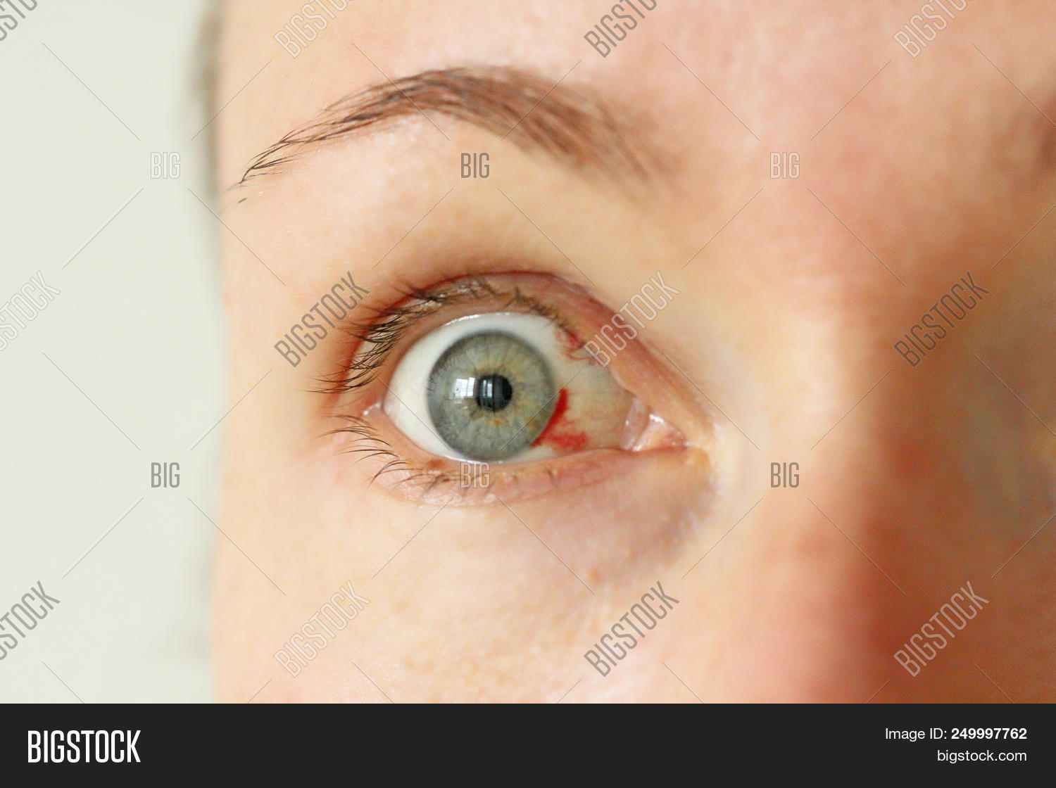 Bloodshot Eye. Woman Image & Photo (Free Trial) | Bigstock