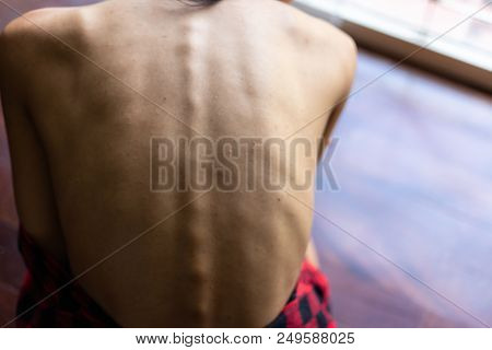 Portrait Anorexia Image & Photo (Free Trial) | Bigstock