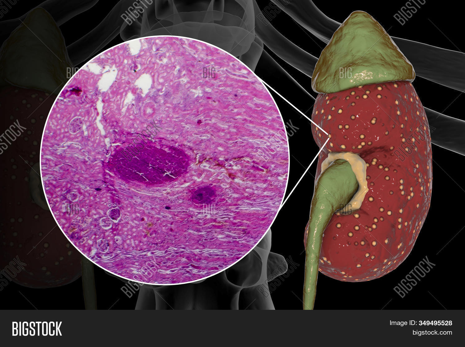 Acute Pyelonephritis, Image & Photo (Free Trial) | Bigstock
