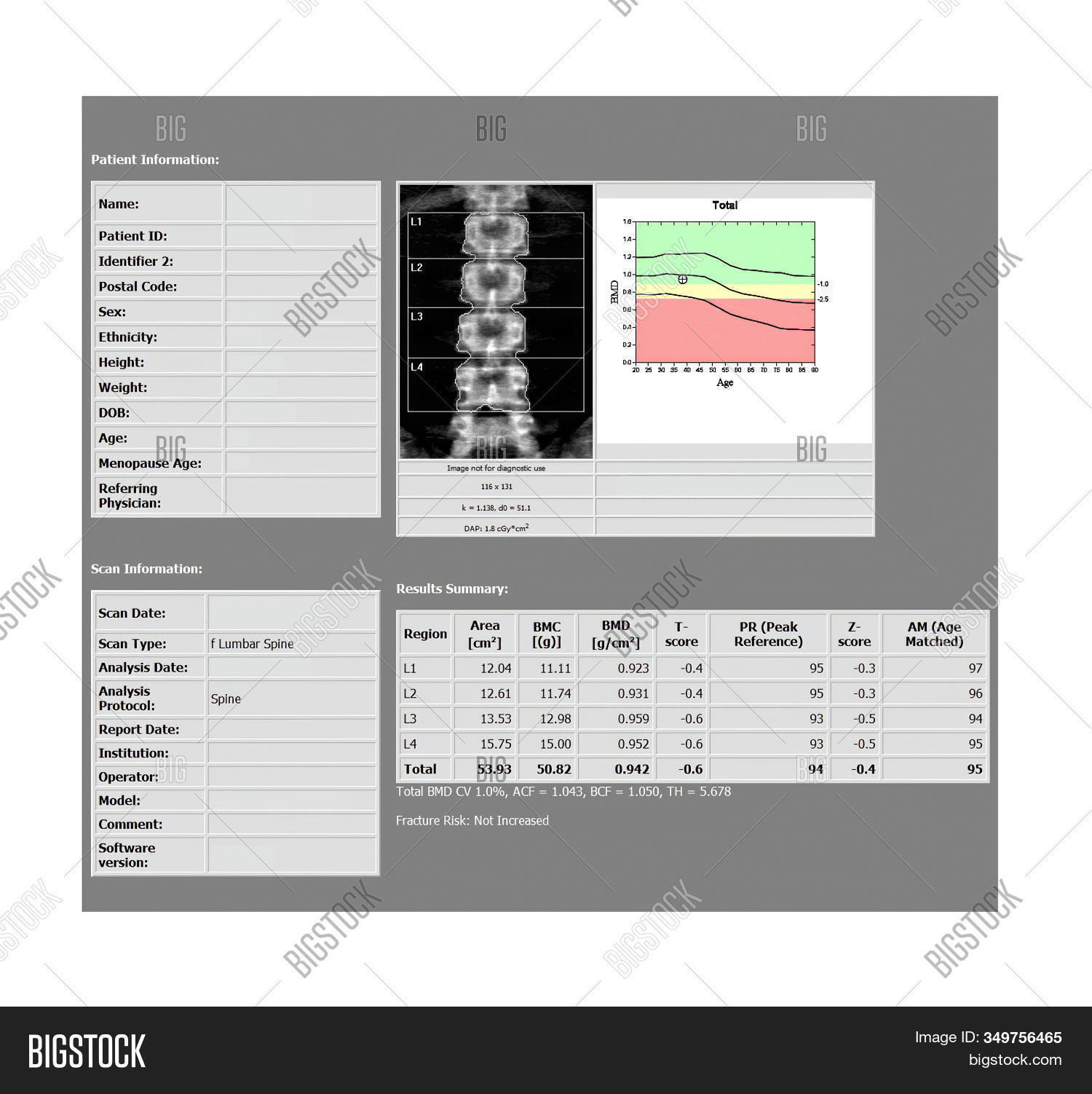 Dexa Densitometry Image & Photo (Free Trial) | Bigstock