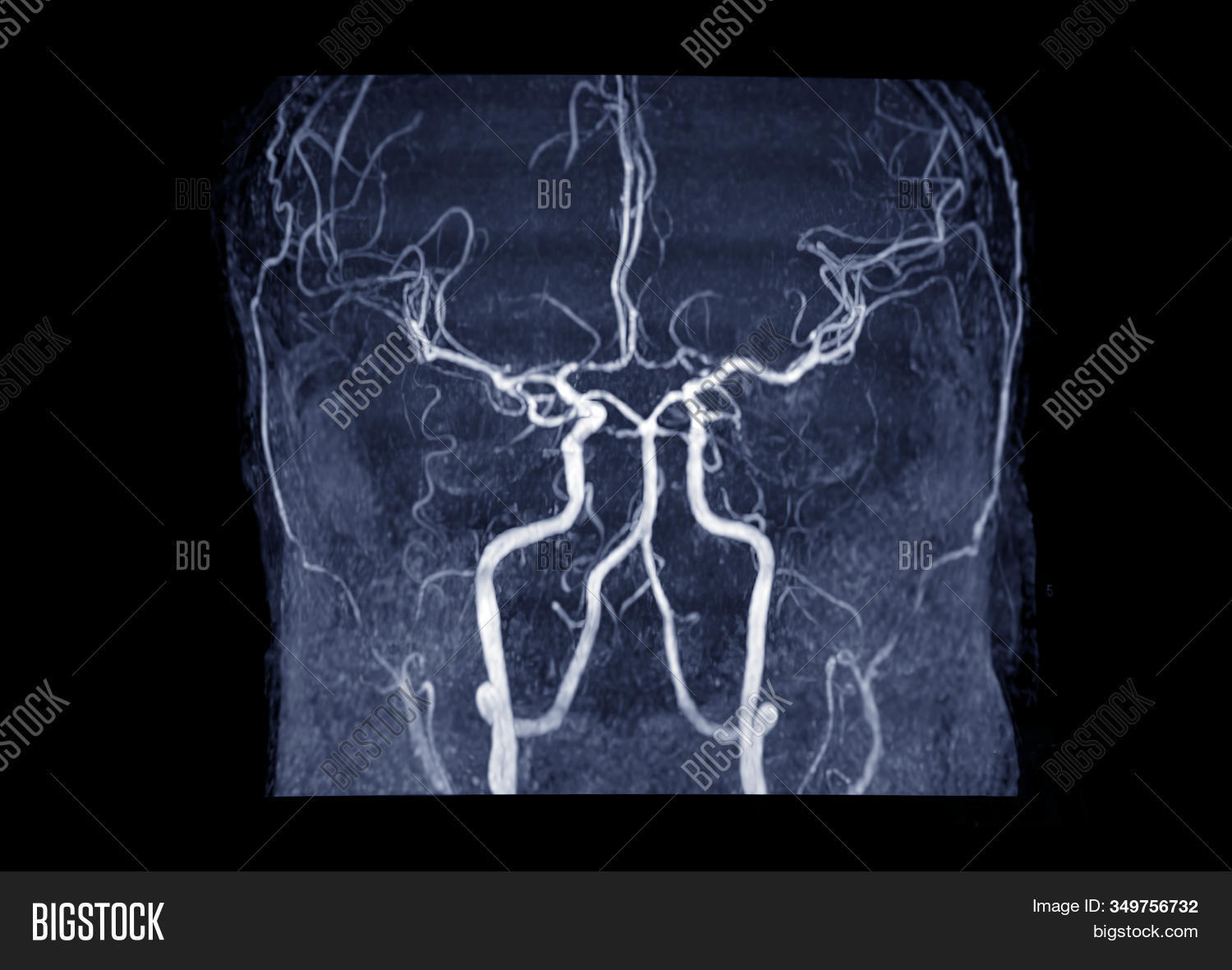MRA Brain Neck Image & Photo (Free Trial) | Bigstock