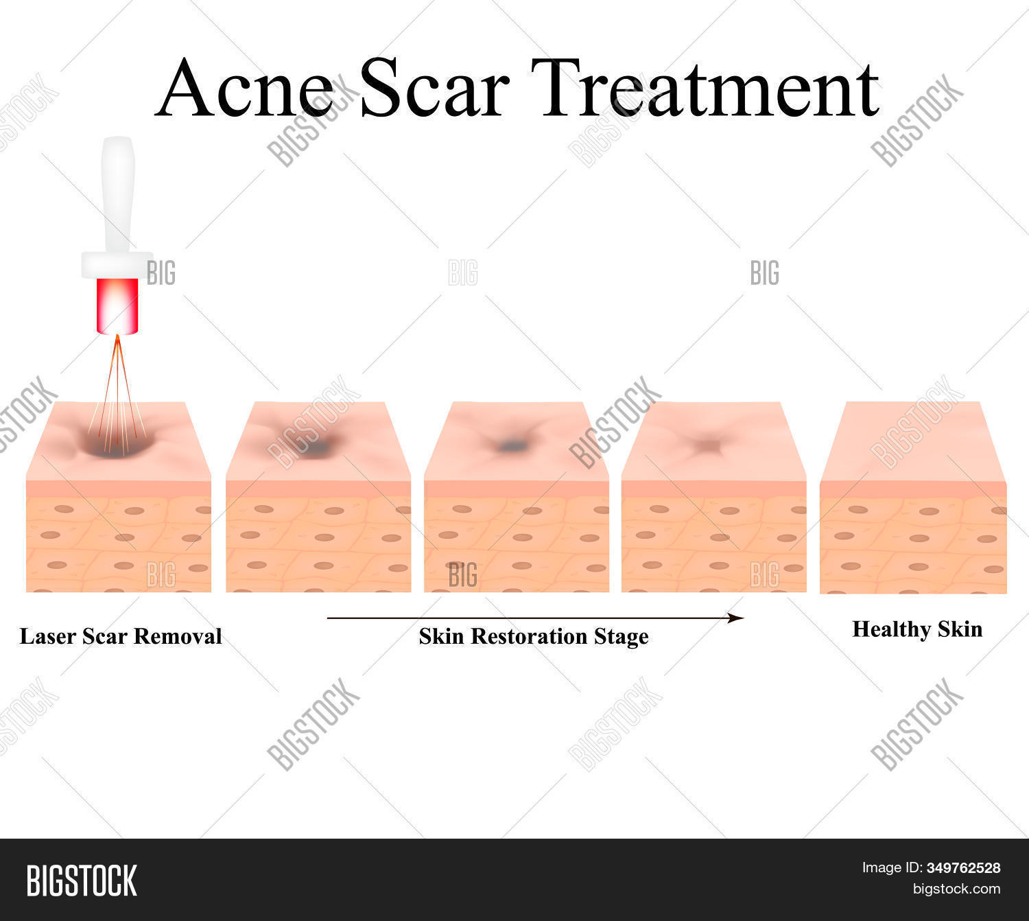 Acne Scars. Laser Scar Image & Photo (Free Trial) | Bigstock