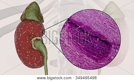 Acute Pyelonephritis, Image & Photo (Free Trial) | Bigstock