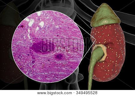 Acute Pyelonephritis, Image & Photo (Free Trial) | Bigstock