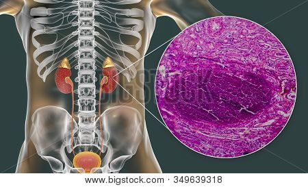 Acute Pyelonephritis, Image & Photo (Free Trial) | Bigstock