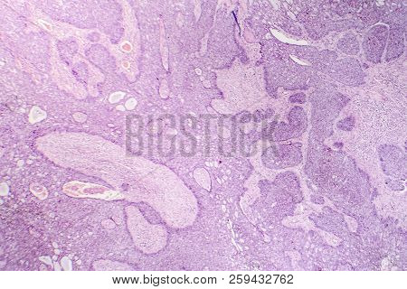 Basal Cell Carcinoma, Image & Photo (Free Trial) | Bigstock